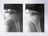 Buy NEURO-LUX ® II Shoulder Brace